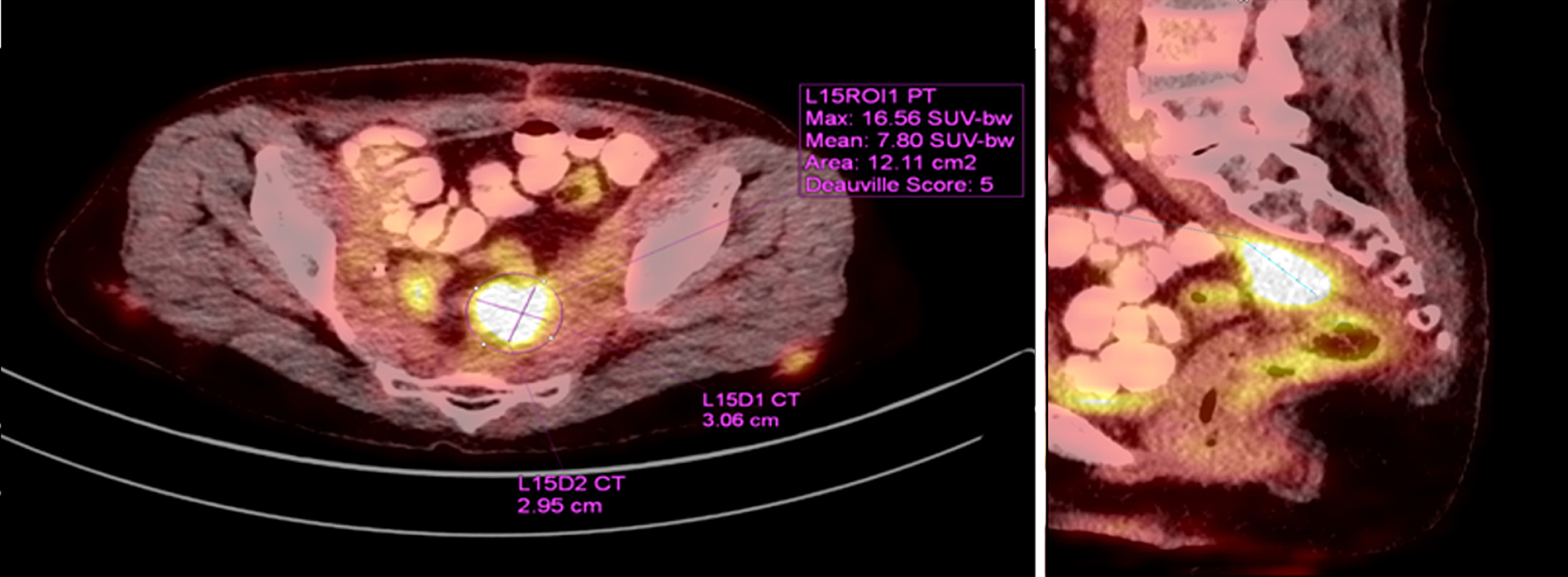 Interdisciplinary Management of Cervical Cancer Relapse with Unusual ...