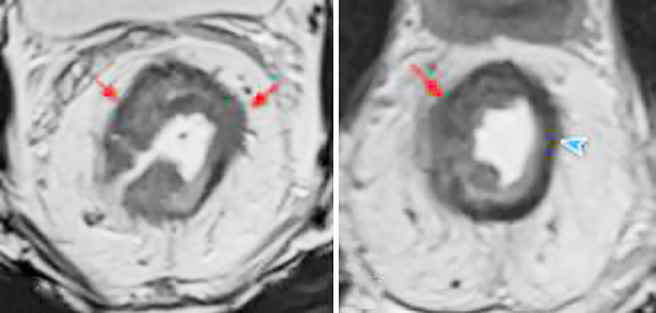 Evaluation of Preoperative Chemoradiotherapy Outcomes in Patients with ...