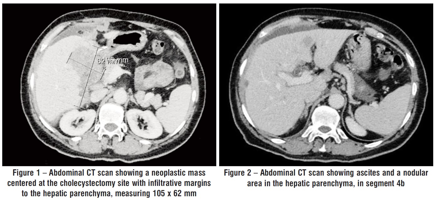 Gallbladder Sarcomatoid Carcinoma - A Rare and Unexpected Finding after ...
