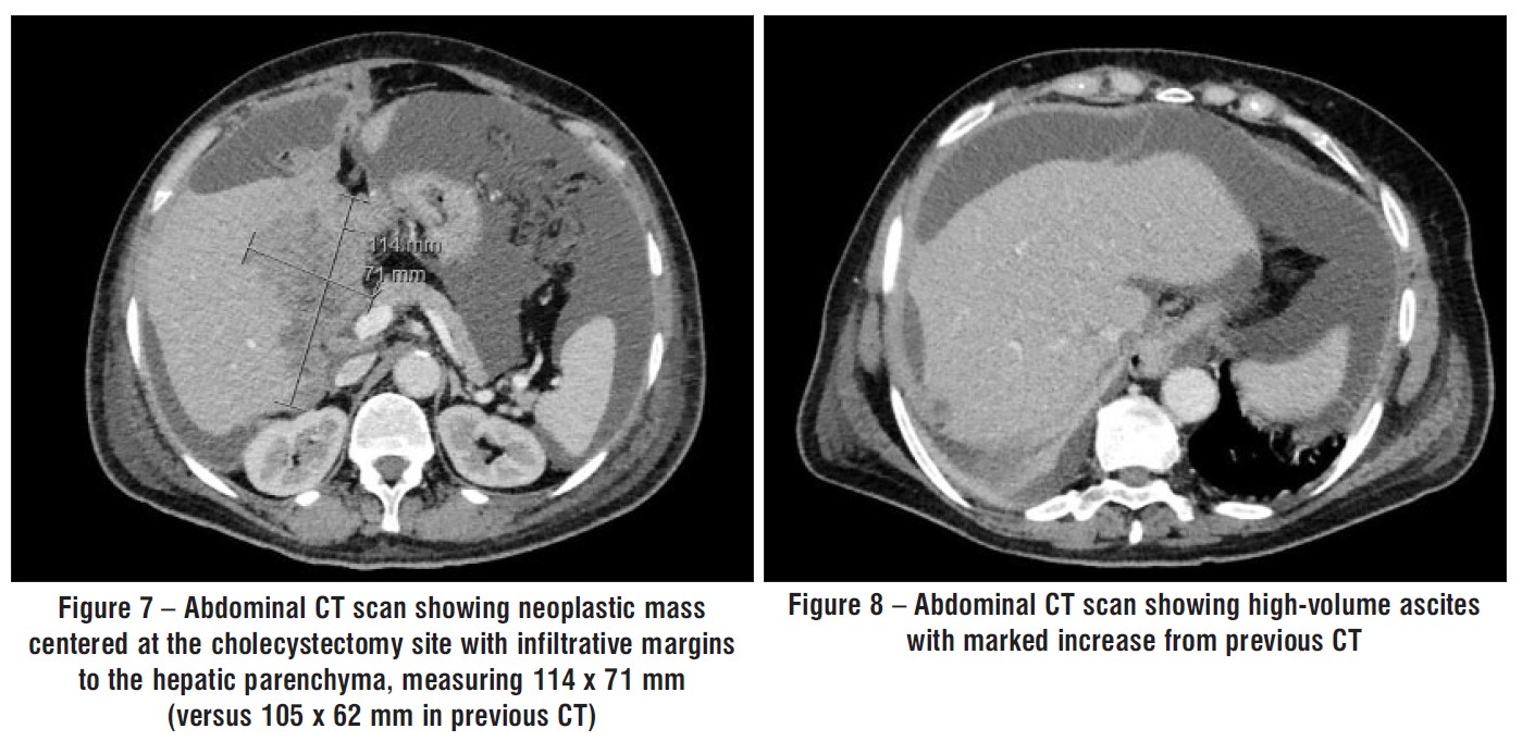 Gallbladder Sarcomatoid Carcinoma - A Rare and Unexpected Finding after ...