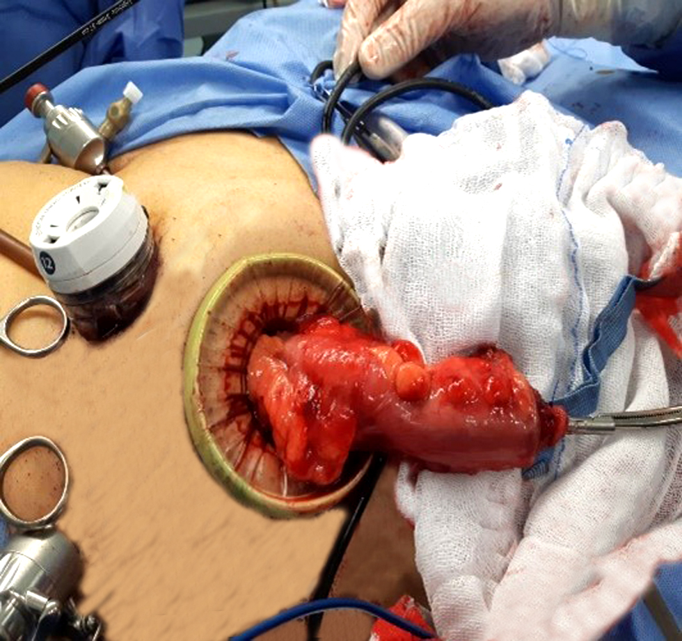 Procedure Voor Luscolostomie Uncut Diverting End Colostomy: End Of